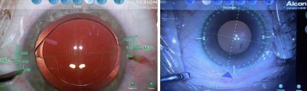 白内障手術など | 柳津あおやま眼科クリニック